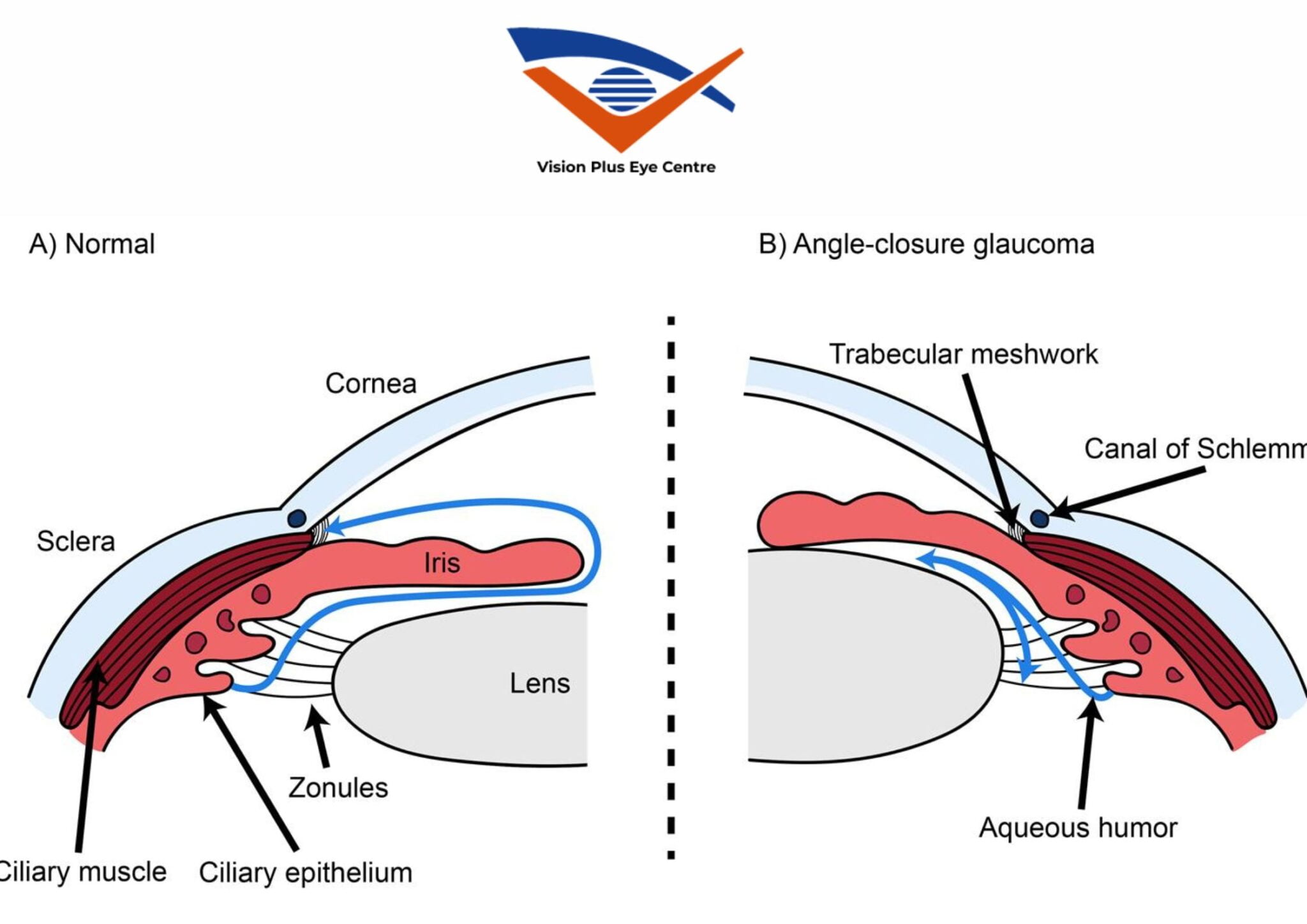 Types of Glaucoma: Open-Angle vs. Angle-Closure